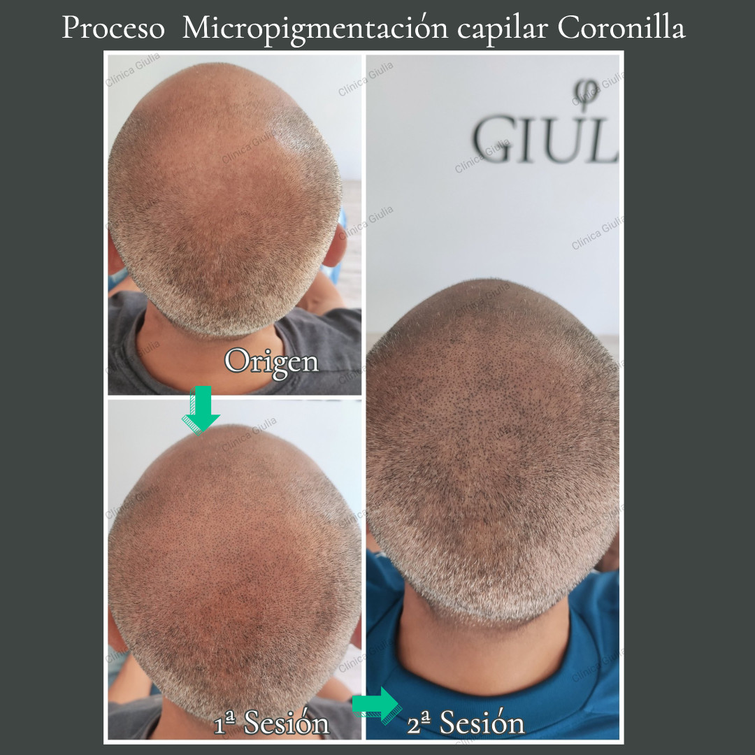 Micropigmentación capilar para hombre