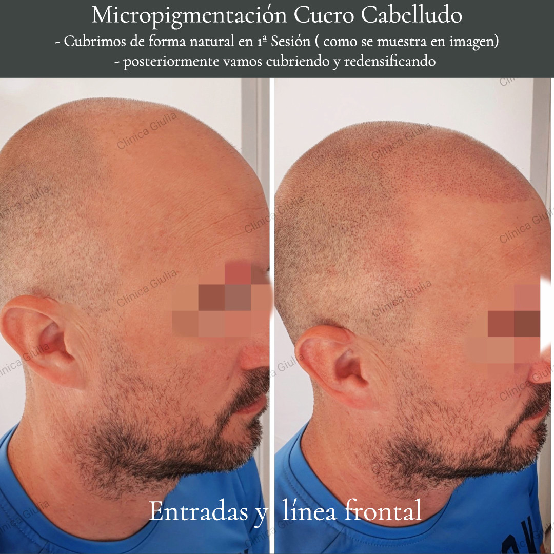 Micropigmentación capilar para hombre