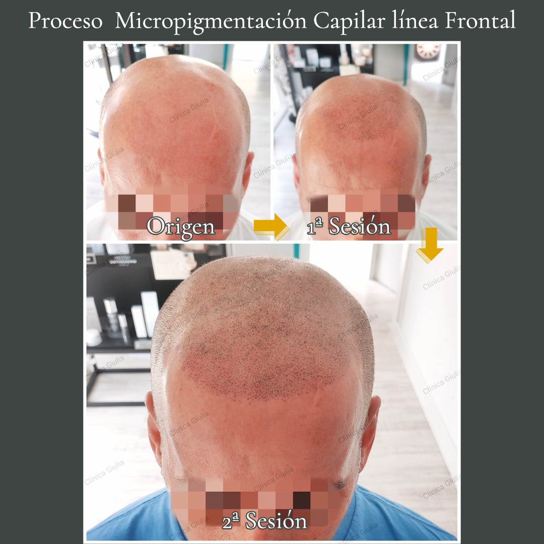 Micropigmentación capilar para hombre